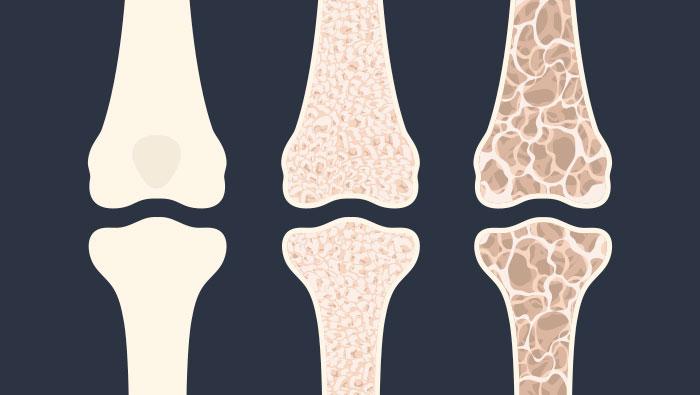 ¿Qué es la osteopenia? | Club Familias